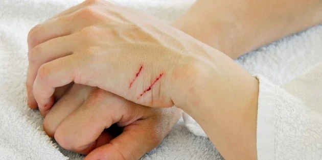 Six Natural Treatments For Lightening Scars — Idea Digezt